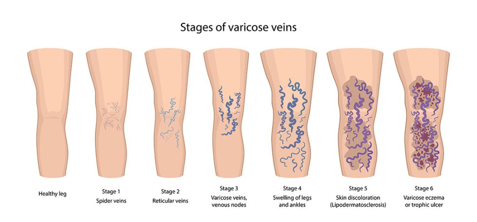Essential Guide To Vein Disease Symptoms | CURA Vein & Pain